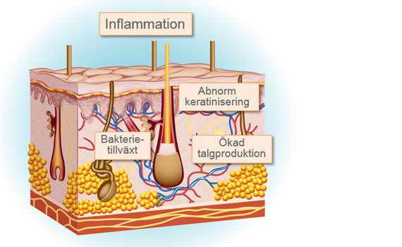 Acnatac - receptbelagt läkemedel mot akne